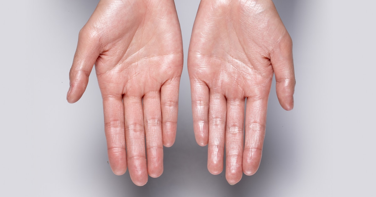 Can miraDry® Be Used for Feet and Hands? - WIFH