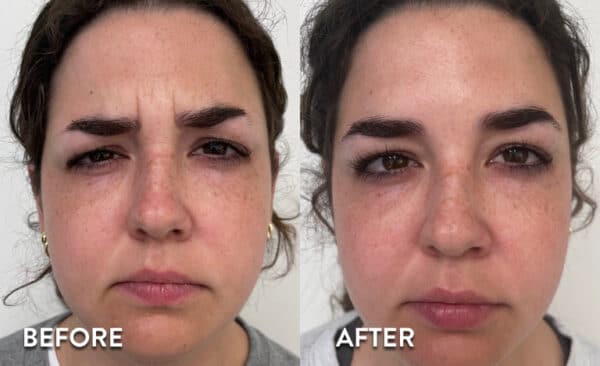Get Rid of Frown Lines with Fillers & Injectables - WIFH