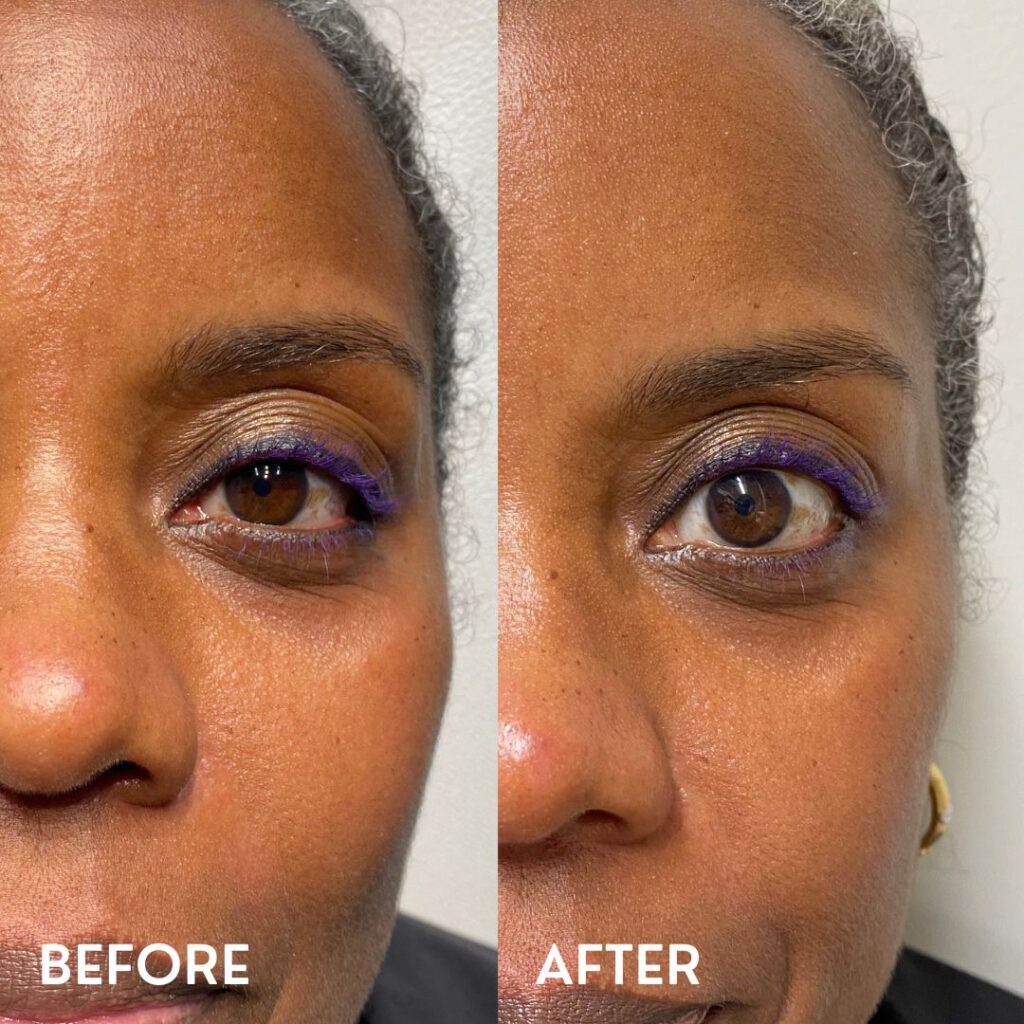 Upneeq® Eye Drops: Benefits, Side Effects & Where to Buy - WIFH