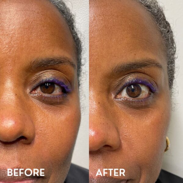 Upneeq® Eye Drops: Benefits, Side Effects & Where to Buy - WIFH